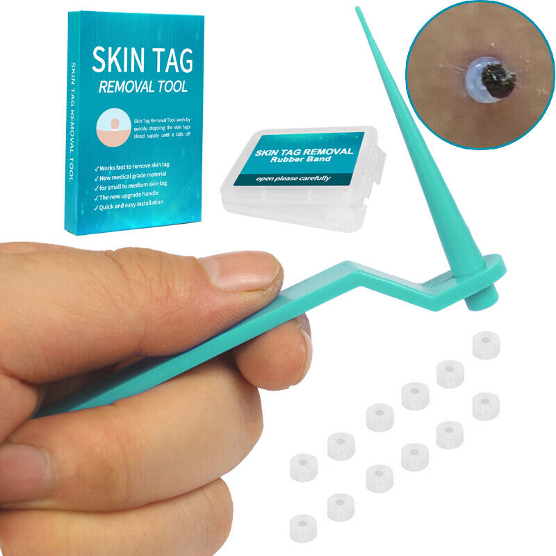 NEW Micro Skin Tag Remover Rubber Bands For Tag Remover Wart Remove Ac ...